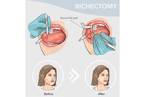 Advantages and Disadvantages of Having a Bichectomy | LTC News